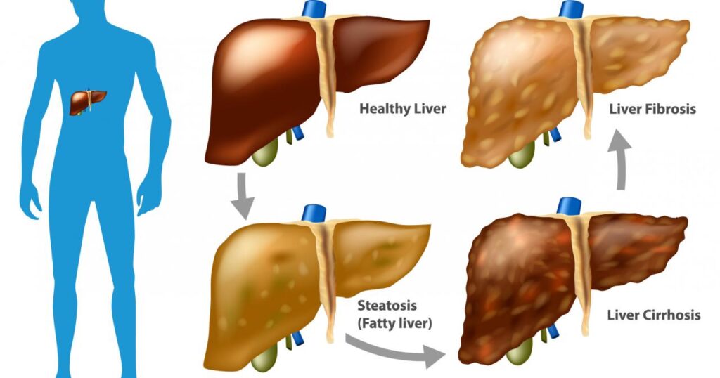 What is Grade 3 Fatty Liver and How to Manage It? | SanteNews
