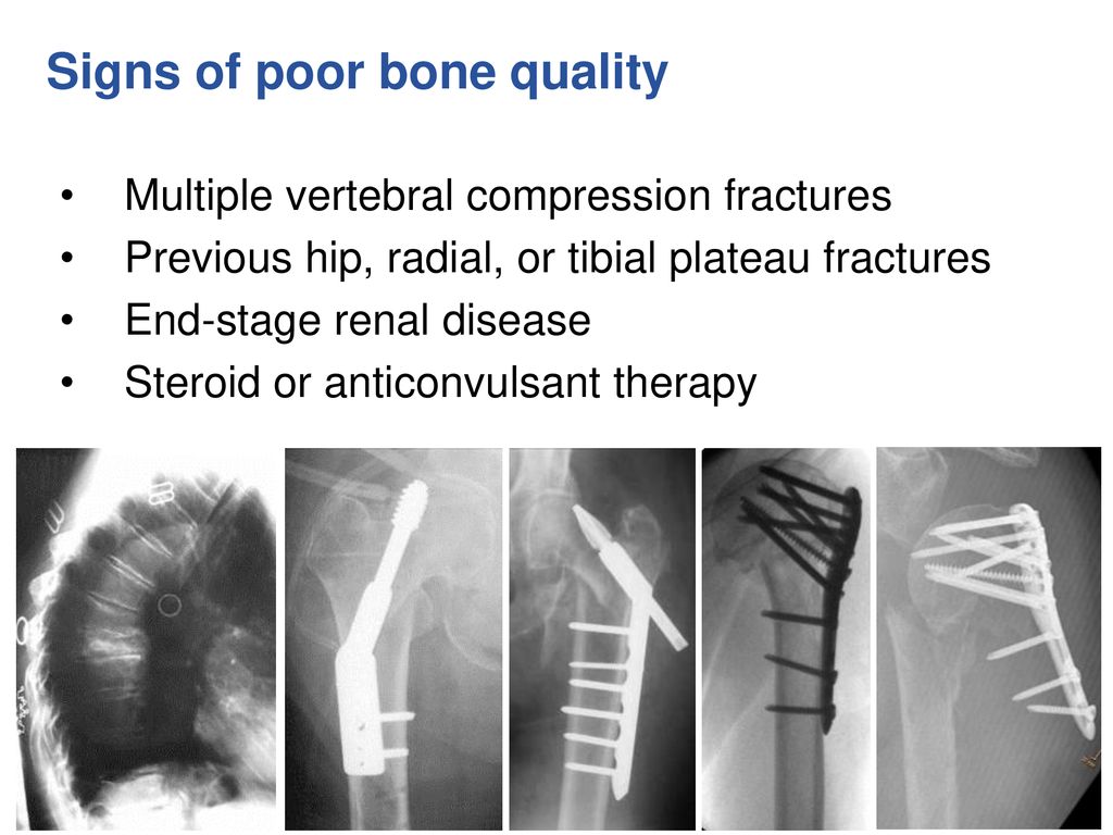 Early Signs of Osteopenia & Osteoporosis Prevention Tips | SanteNews