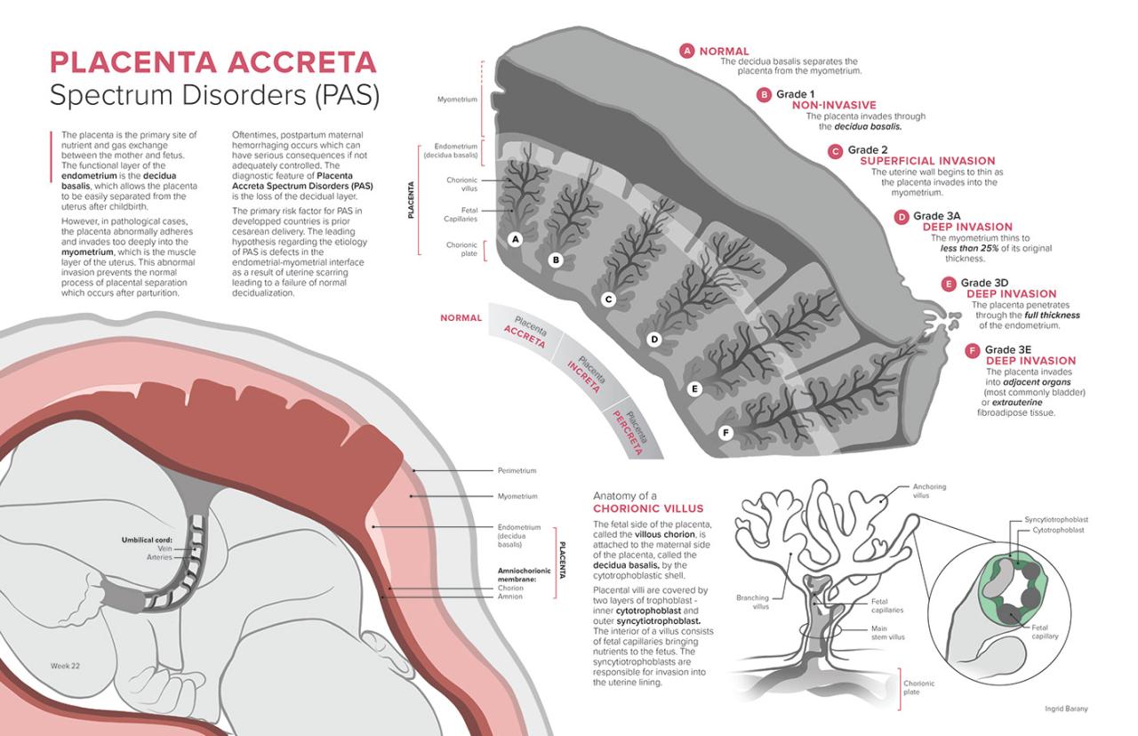 What is Placenta Accreta Symptoms, Types, Diagnosis & Treatment | SanteNews
