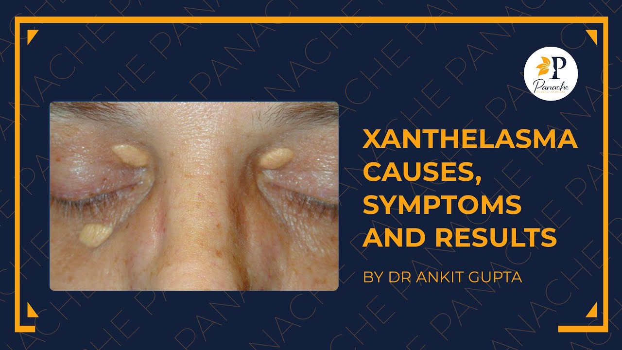 What is Xanthelasma Know Symptoms, Causes, Treatment | SanteNews