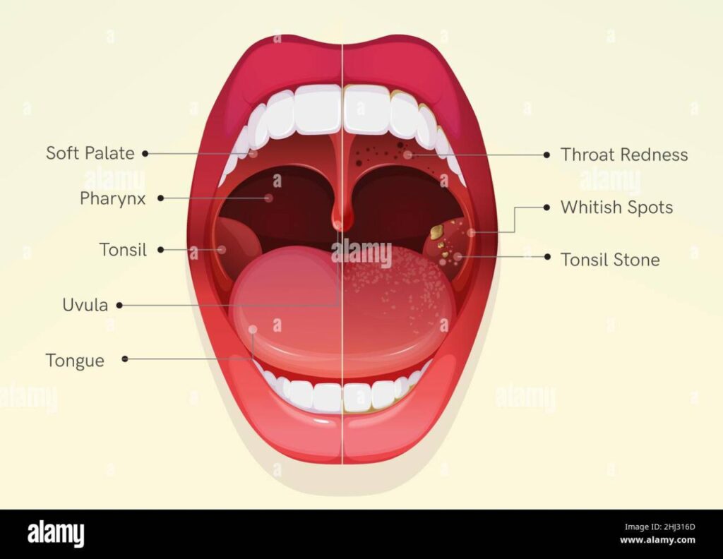 How to Differentiate Sores on Roof of Mouth | SanteNews